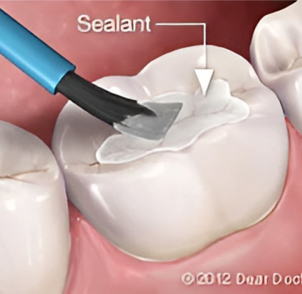Tooth Decay Prevention | Chadds Ford Dental Tips