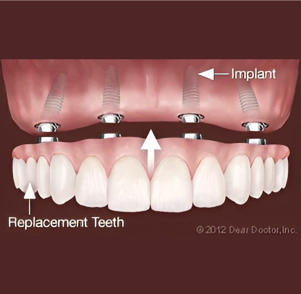 Dental Implants | Permanent Solutions at Chadds Ford Dental